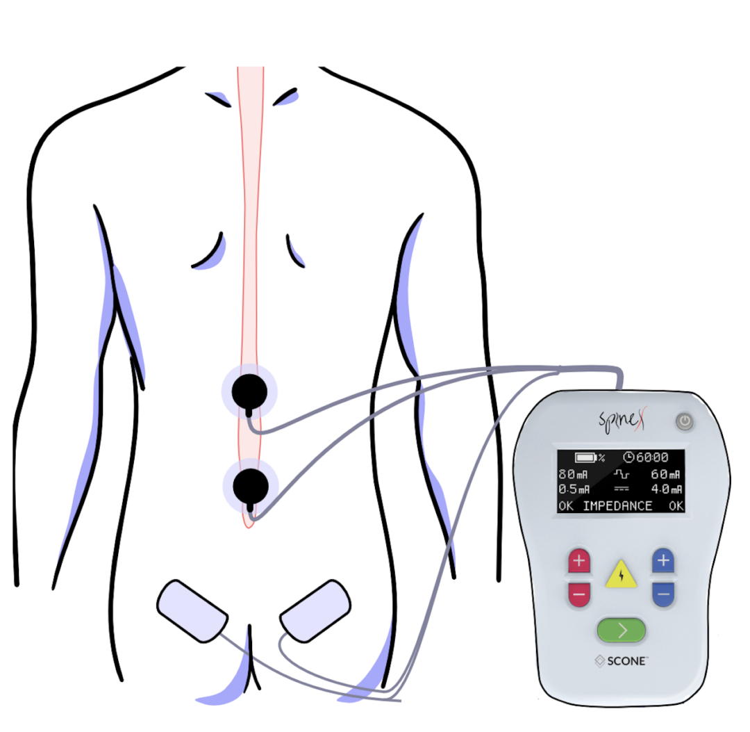 Neuromodulation for bladder function (SCONE clinical study) | ICORD